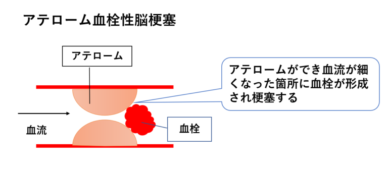 脳梗塞の種類、症状、救急看護の対応のまとめ 看護師kouの医療と旅行まとめ